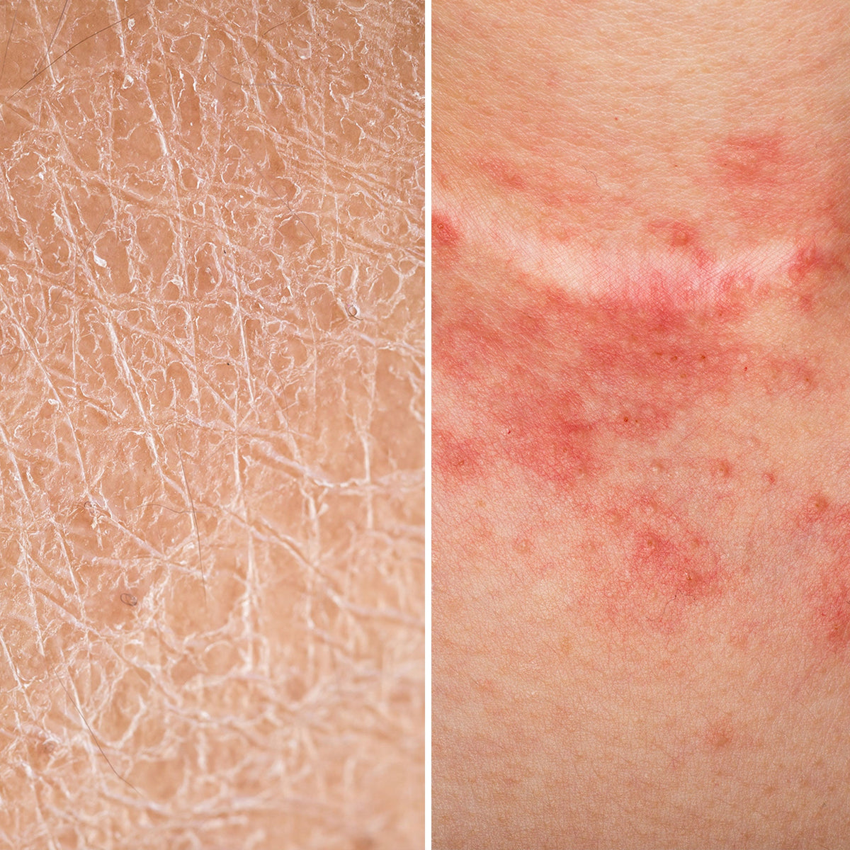 Hydration for Dry Skin: Humectants, Occlusives & Emollients Explained ...